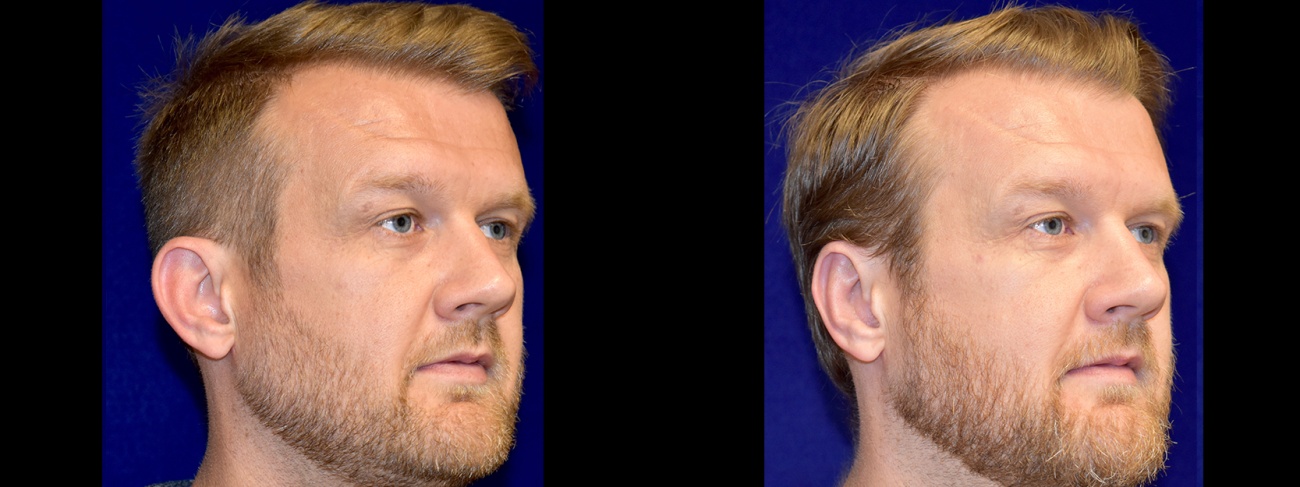Ear Surgery | Paul Pin, MD